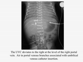 Neonatal Umbilical Venous Catherization Radiology | PPT