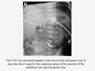 Neonatal Umbilical Venous Catherization Radiology | PPT