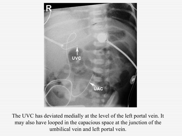 Neonatal Umbilical Venous Catherization Radiology | PPT | Heart and ...