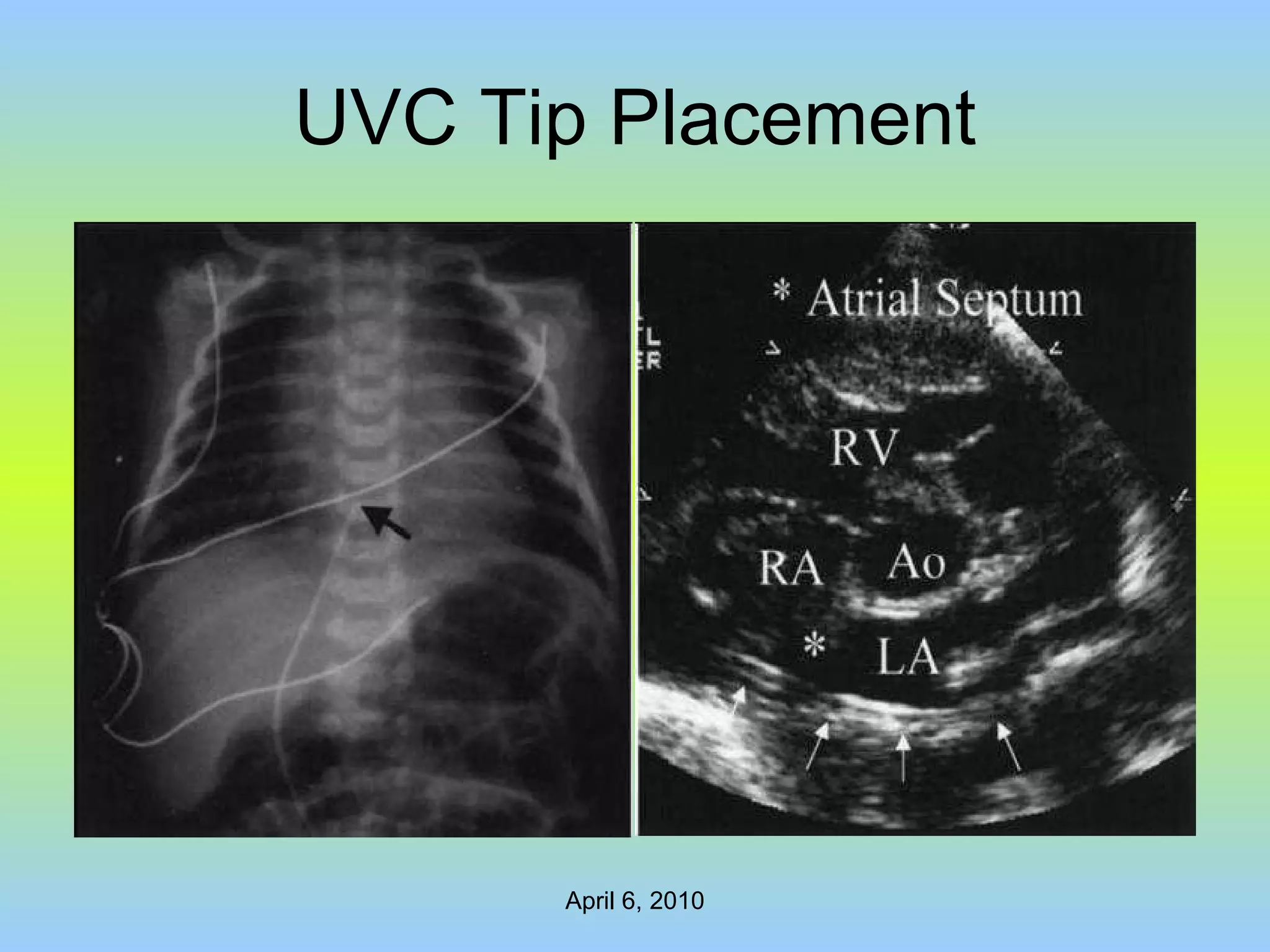 Umbilical Venous Catheter | PPT