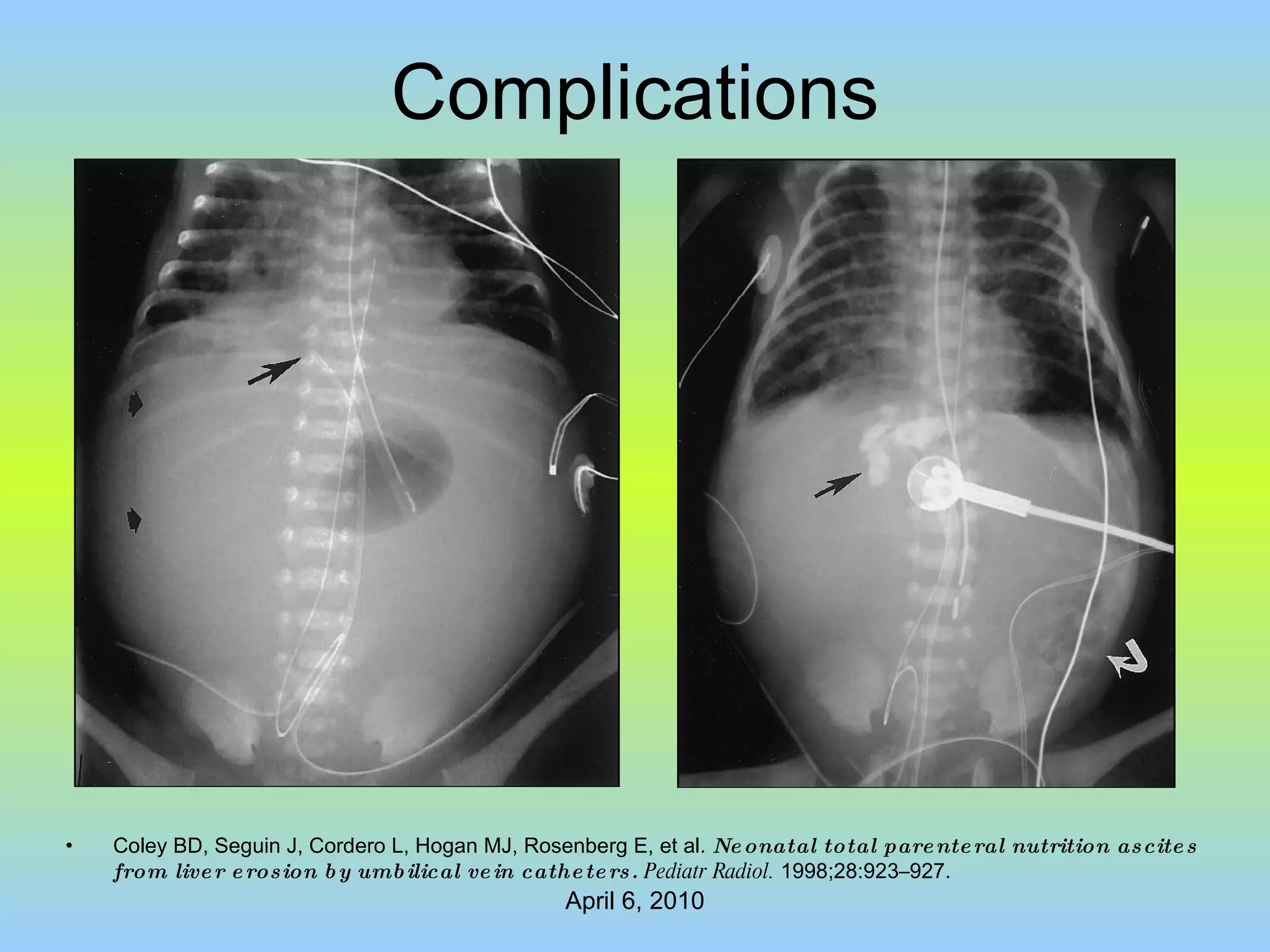 Umbilical Venous Catheter | PPT