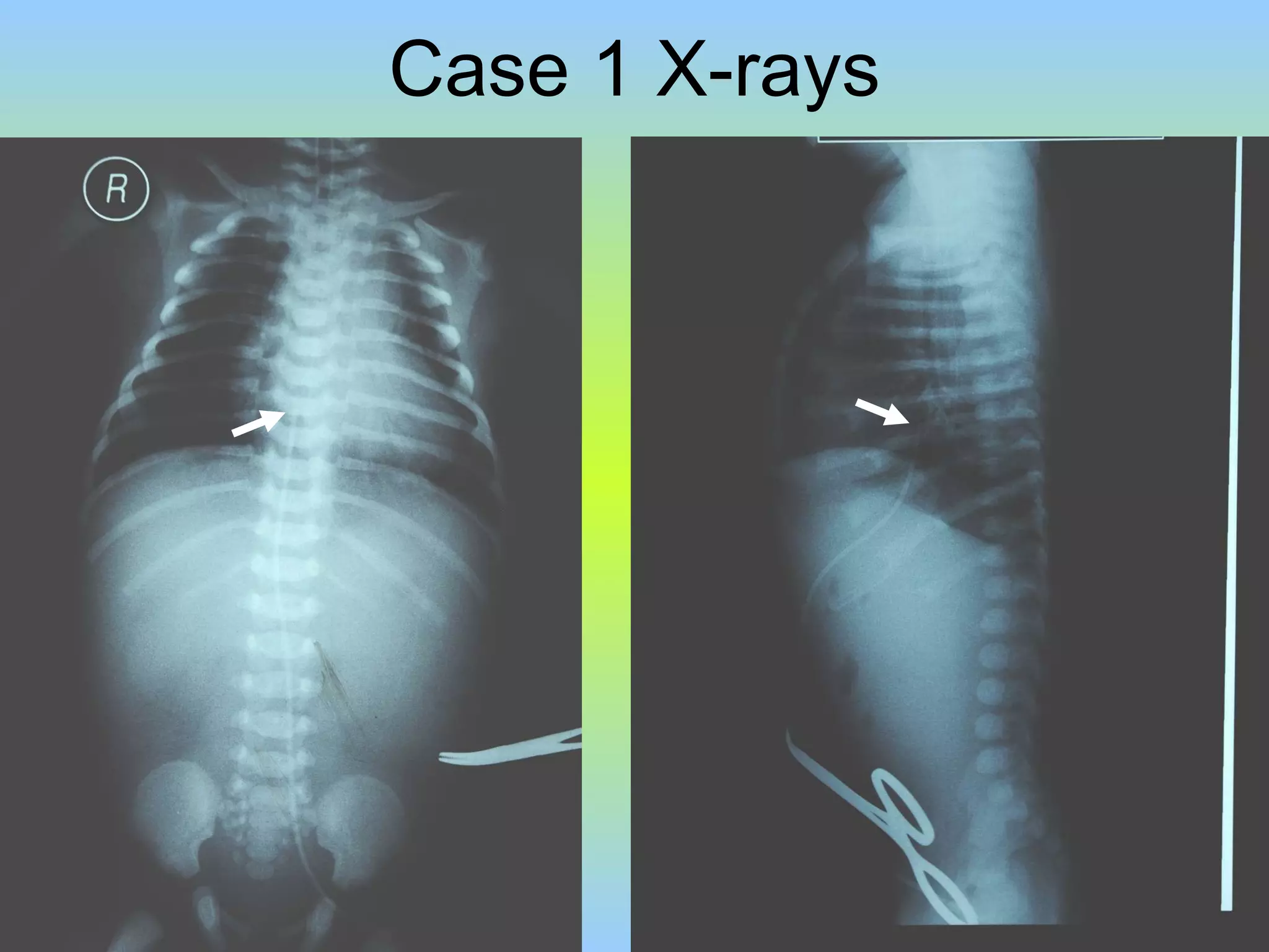 Umbilical Venous Catheter | PPT