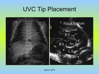 Umbilical Venous Catheter | PPT