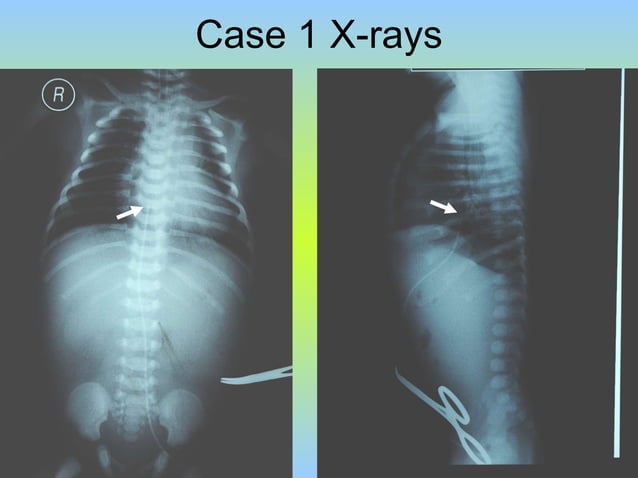 Umbilical Venous Catheter | PPT | Pregnancy | Reproductive Health