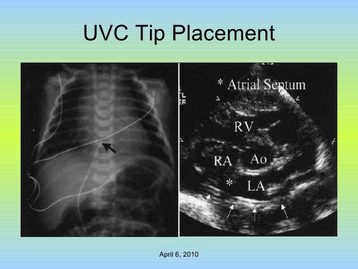 Umbilical Venous Catheter