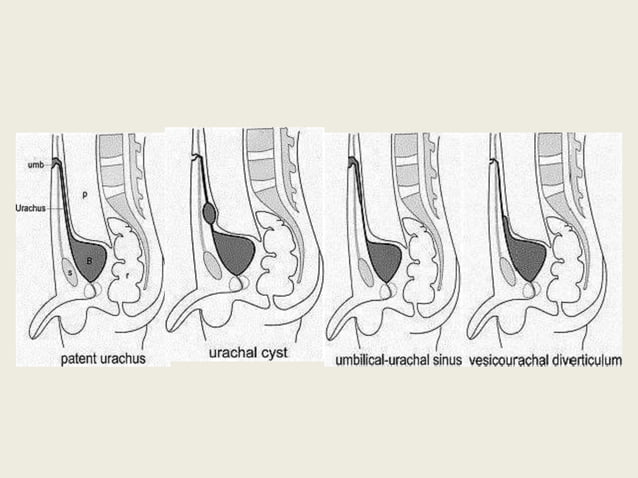 Umbilicus disease | PPTX