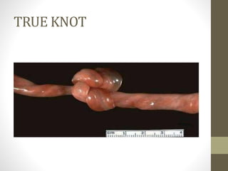 Umblical cord and abnormalities.pptx