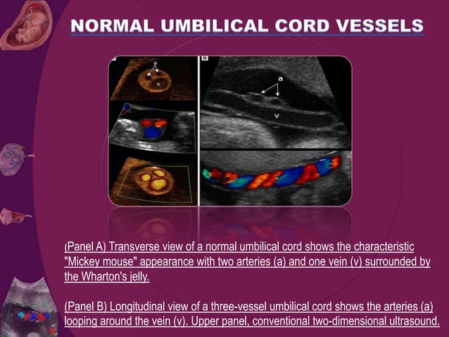 Umblical cord presentation | PPT