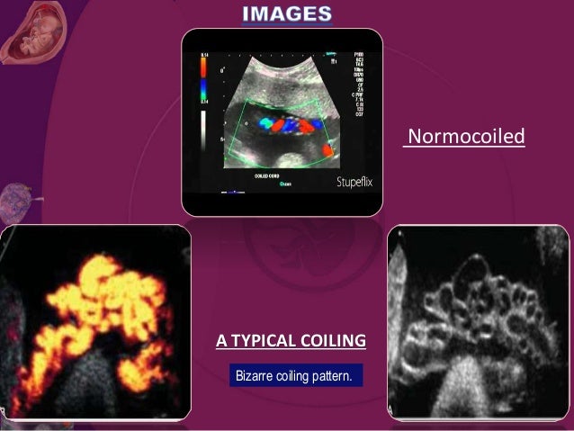 Umblical cord presentation