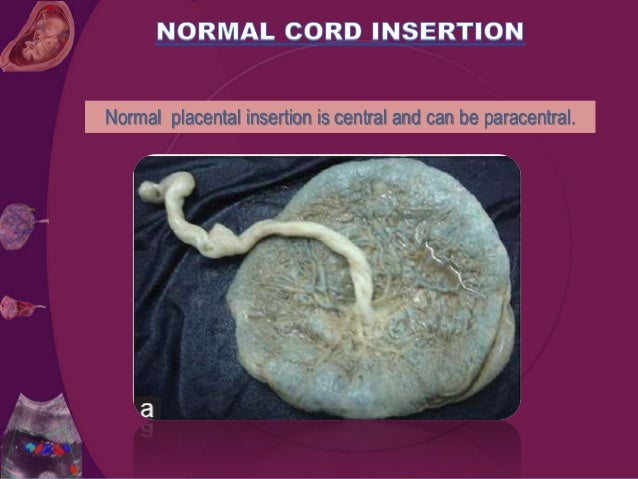 Umblical cord presentation