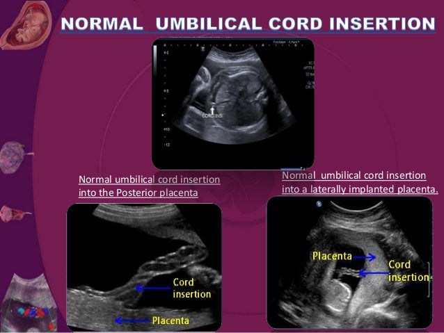 Umblical cord presentation
