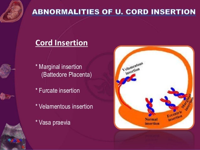 Umblical cord presentation