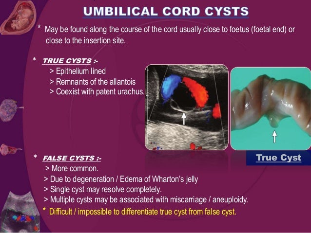Umblical cord presentation