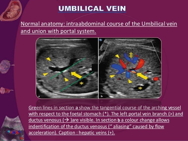 Umblical cord presentation