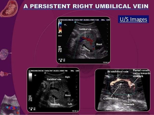 Umblical cord presentation