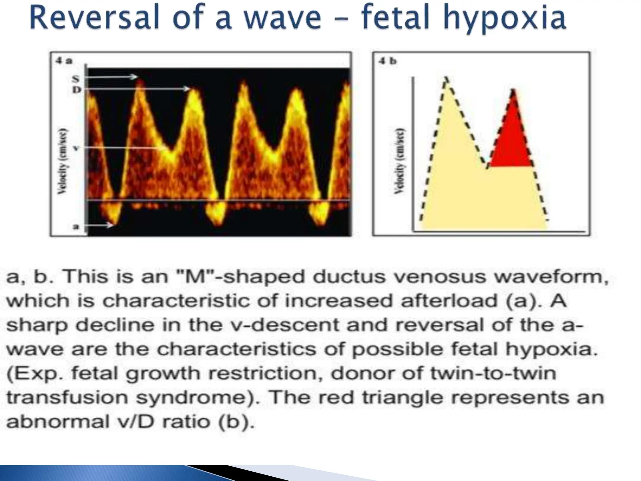 umblical doppler variation _ fetus effect | PPTX | Pregnancy ...