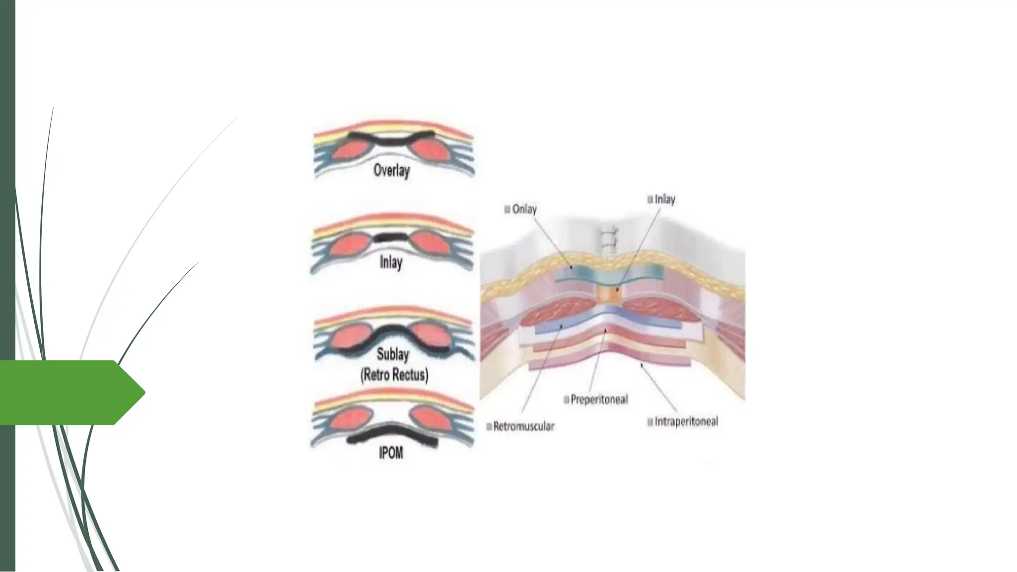 Umblical Hernia By Dr.Pankaj Vishwakarma | PPT