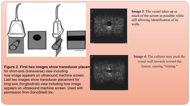 UMC Watford USG-PIV presentation.032515.pptx