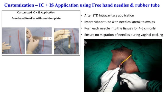 Intracavitary brachytherapy modern day applicators and techniques | PPT