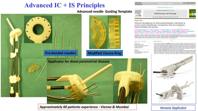 Intracavitary brachytherapy modern day applicators and techniques | PPT