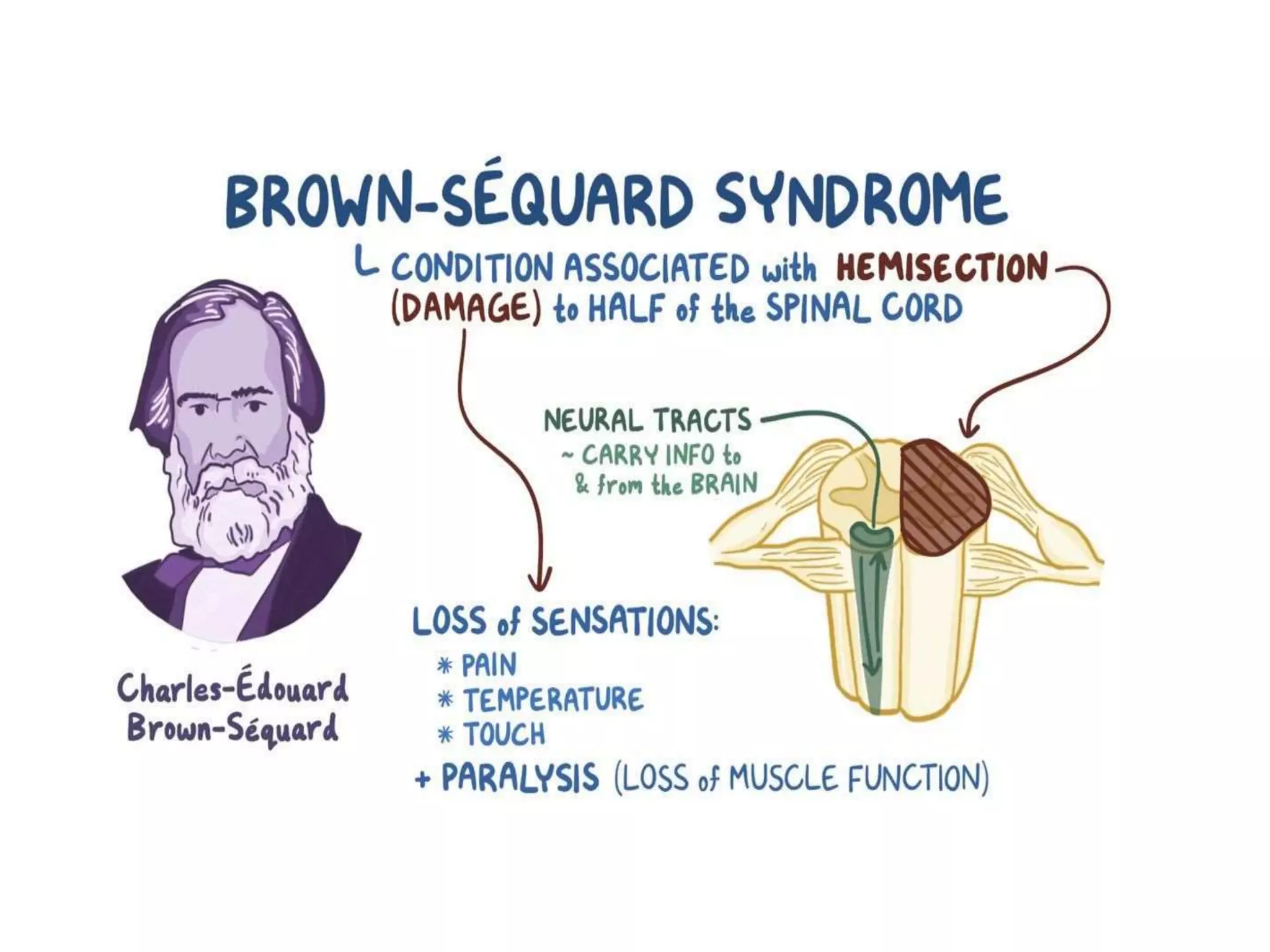 Upper Motor Neuron, Lower Motor Neuron and Brown Sequard Syndrome | PPTX