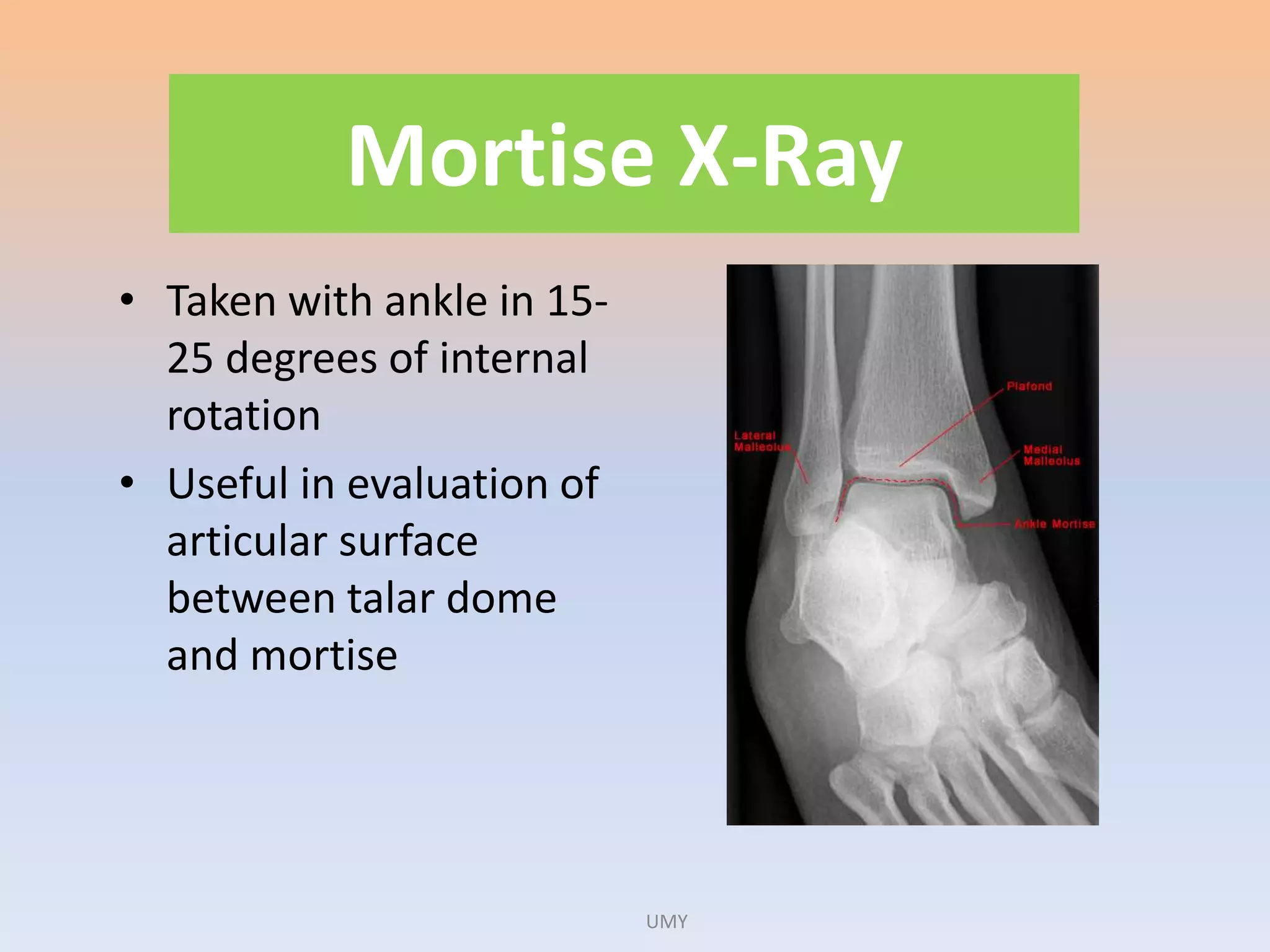 ANKLE FRACTURES | PPTX