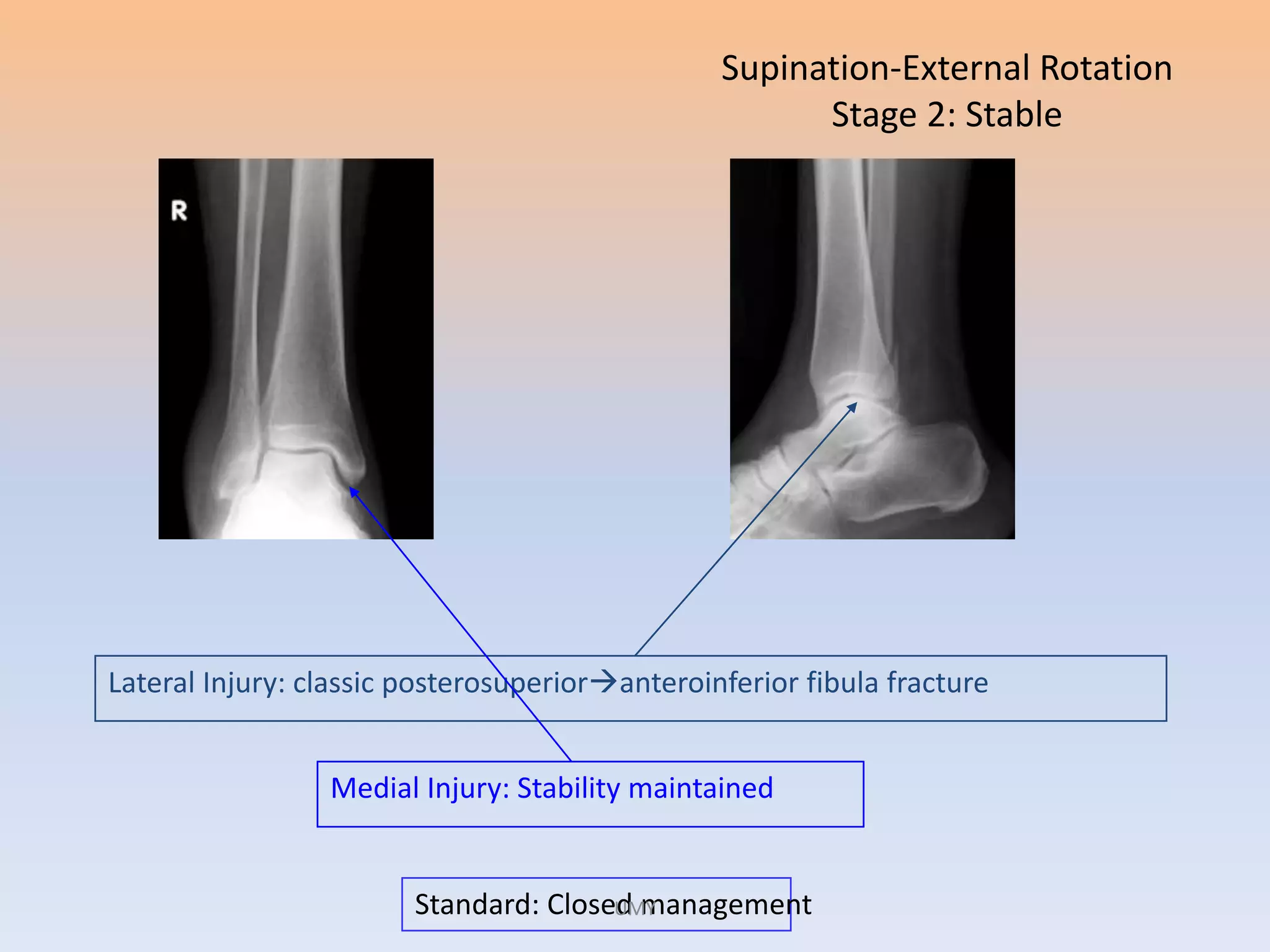ANKLE FRACTURES | PPTX