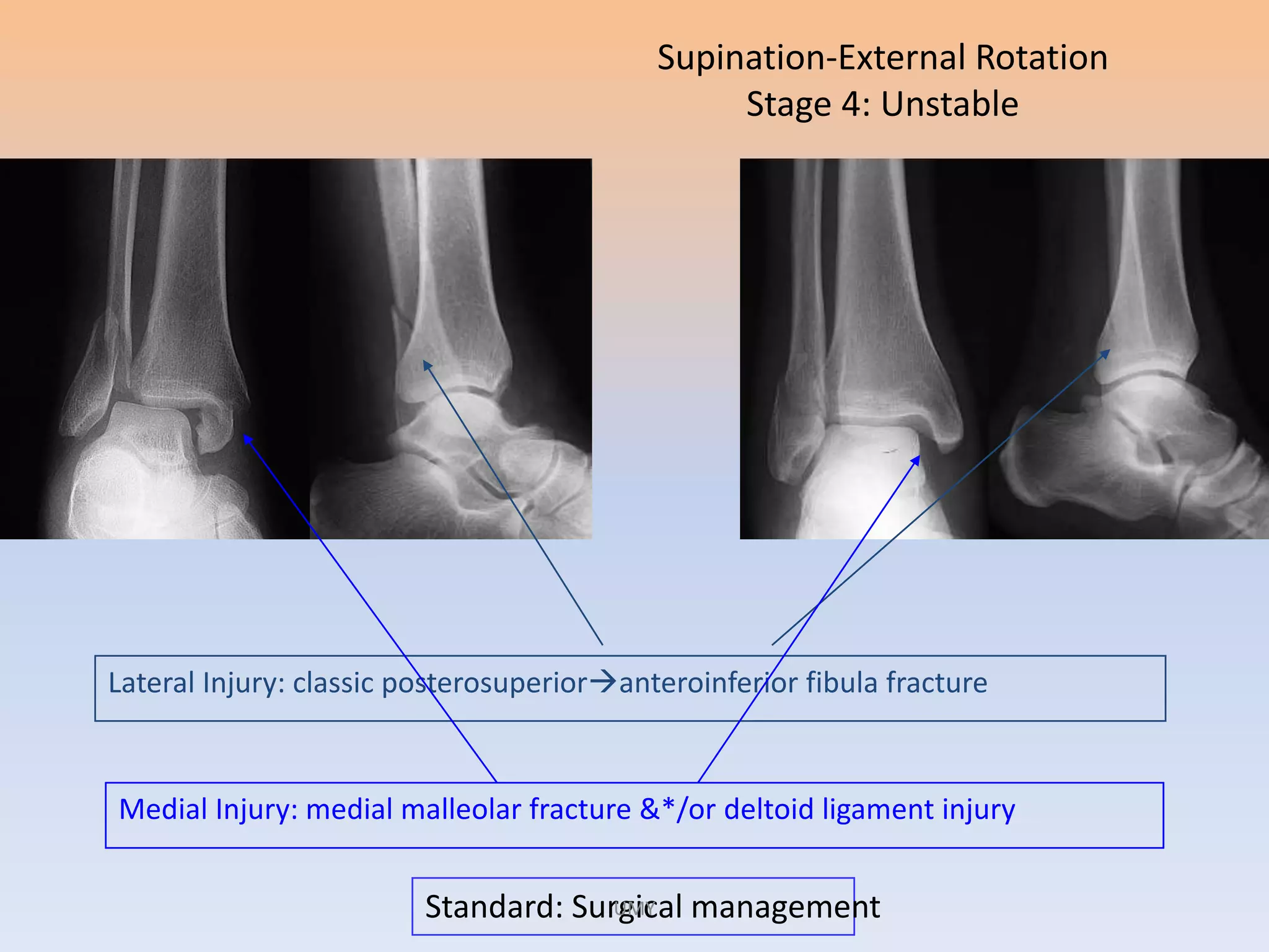 ANKLE FRACTURES | PPTX