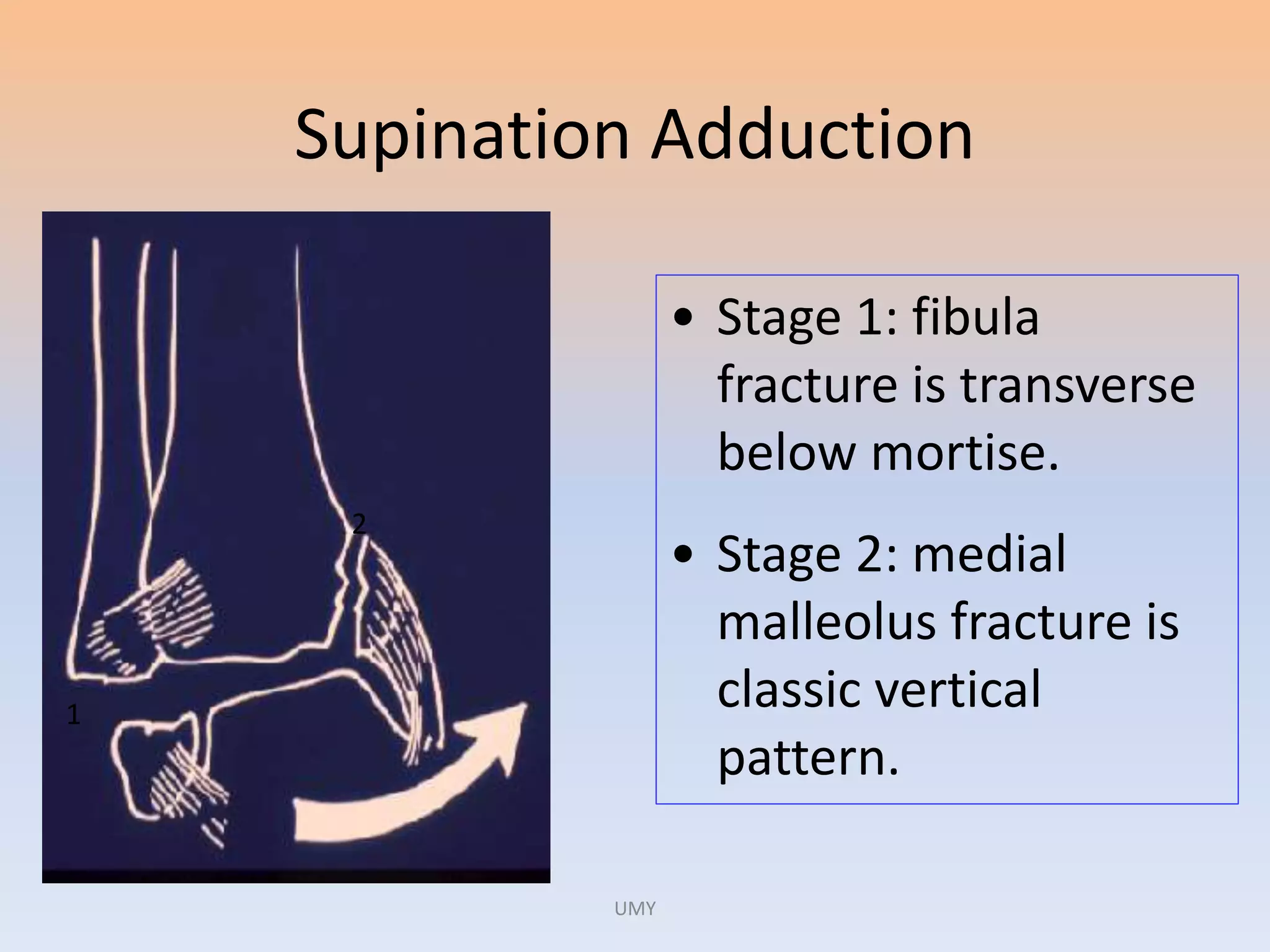 ANKLE FRACTURES | PPTX