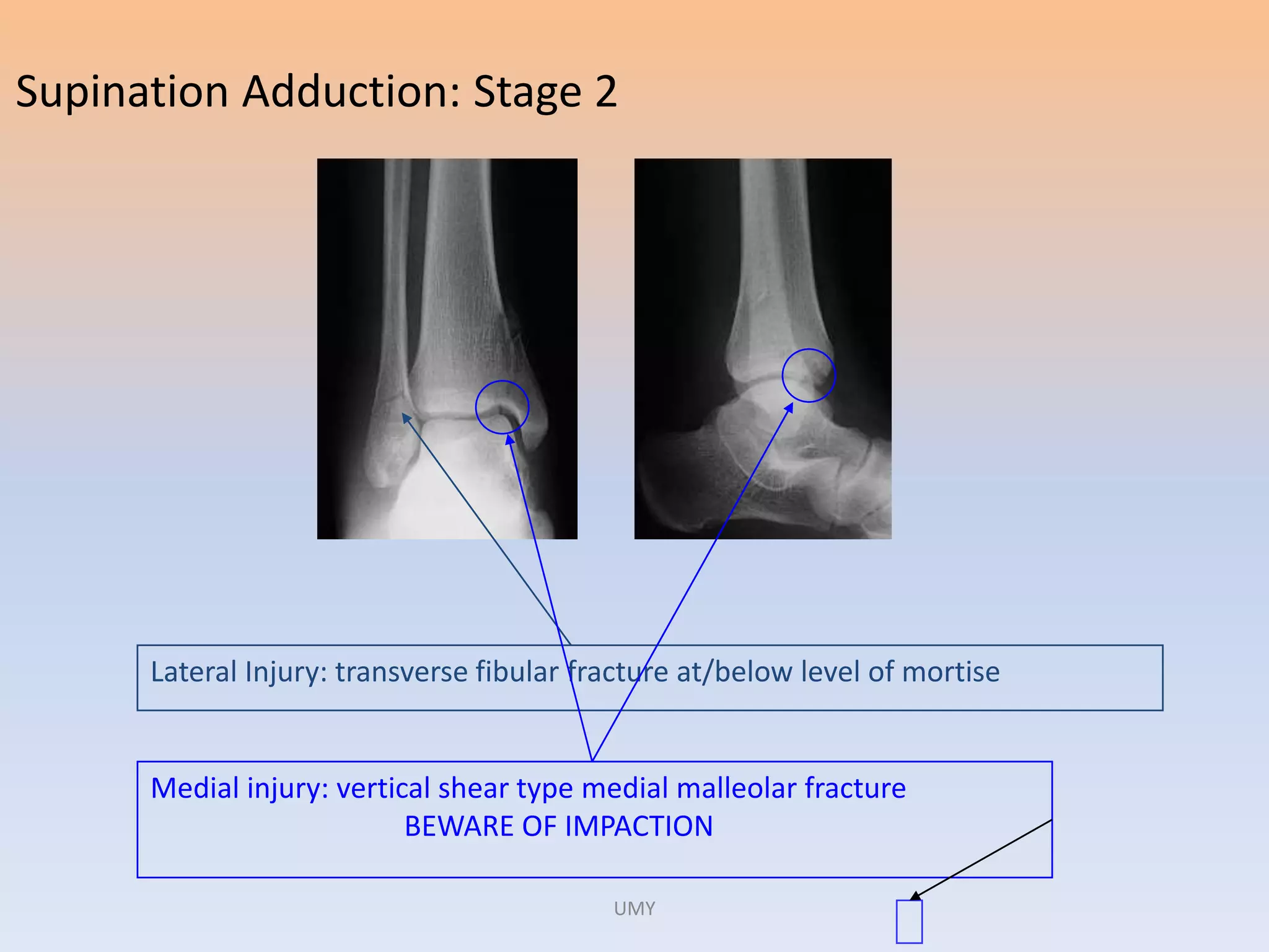 ANKLE FRACTURES | PPTX