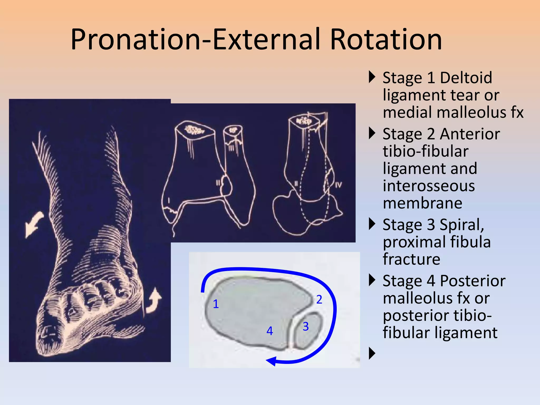 ANKLE FRACTURES | PPTX
