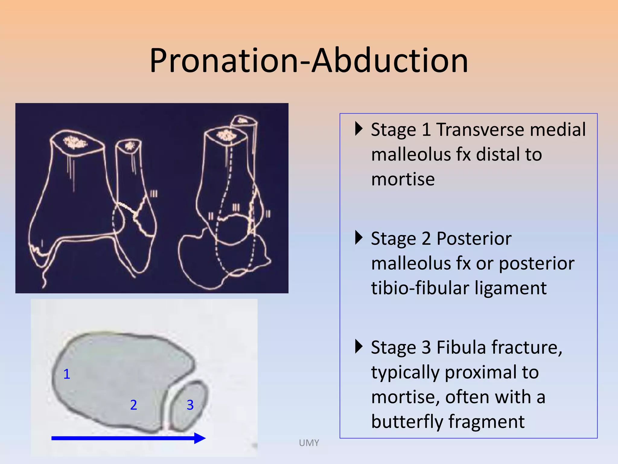 ANKLE FRACTURES | PPTX