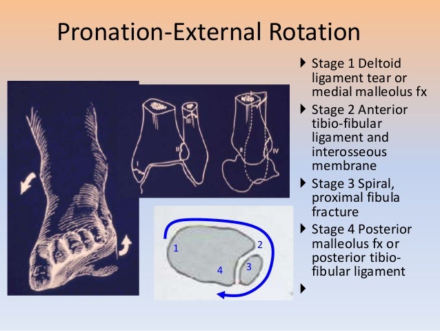 ANKLE FRACTURES