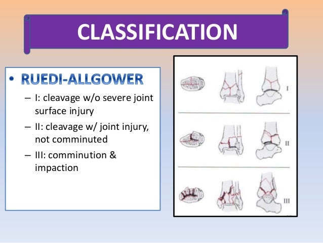 ANKLE FRACTURES