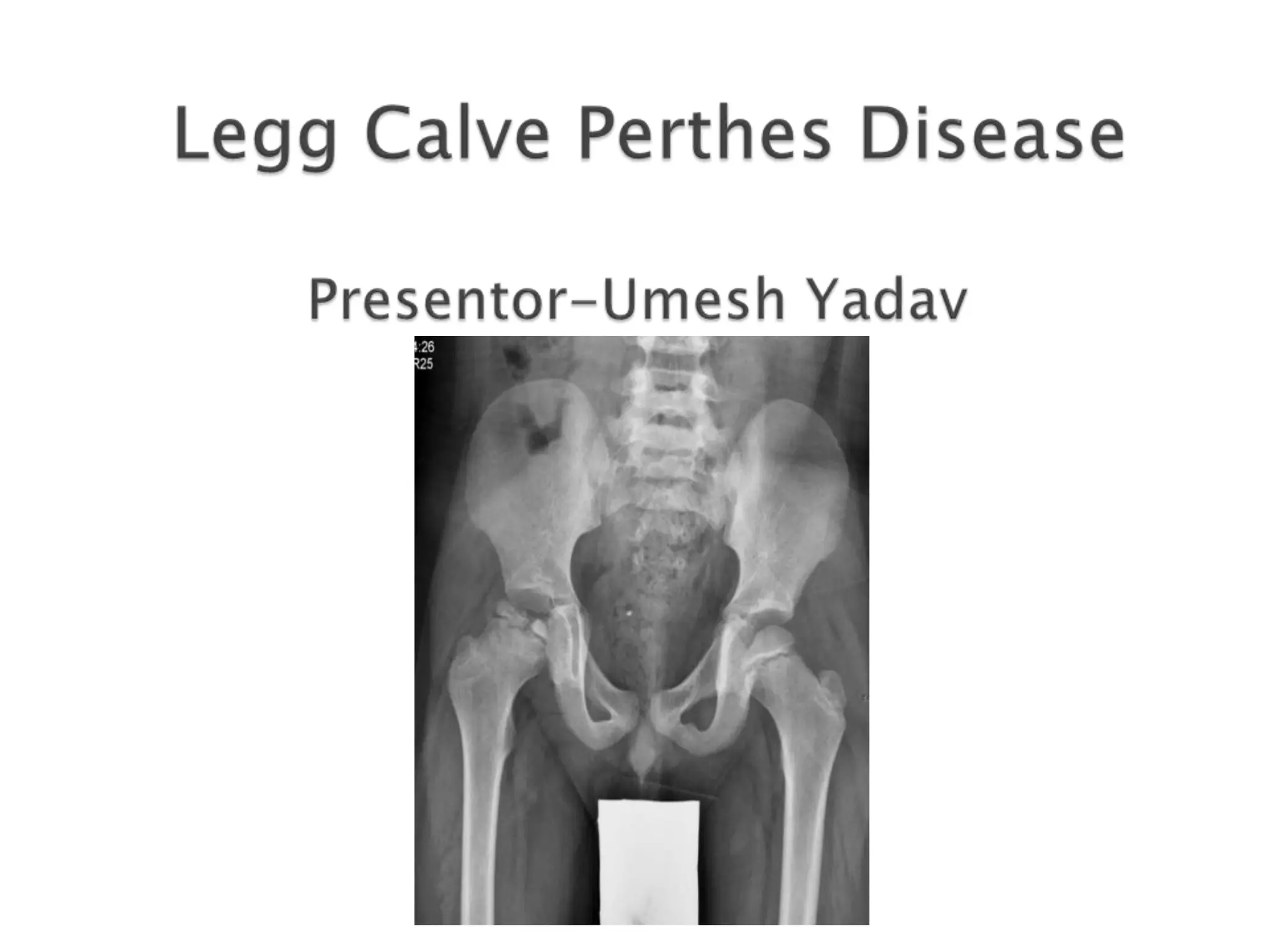 Legg calve perthes disease-UMY | PPTX