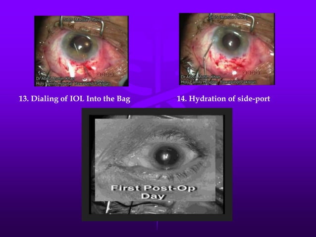 Unaided vision after manual suture less small incision cataract surgery ...