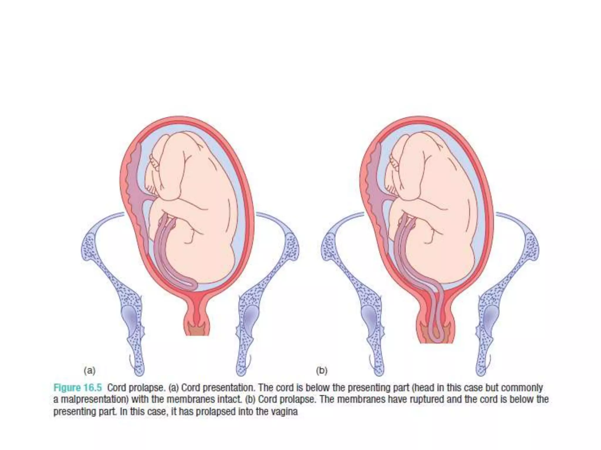 Obstetric emergencies | PPTX