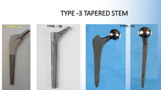 Uncemented femoral stem | PPTX