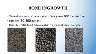 Uncemented femoral stem | PPTX