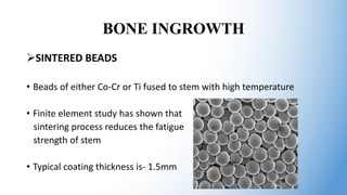 Uncemented femoral stem | PPTX