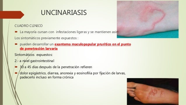 Uncinariasis.