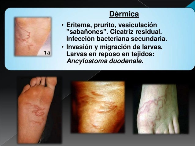 Uncinariasis: Necator americanus y Ancylostoma duodenale