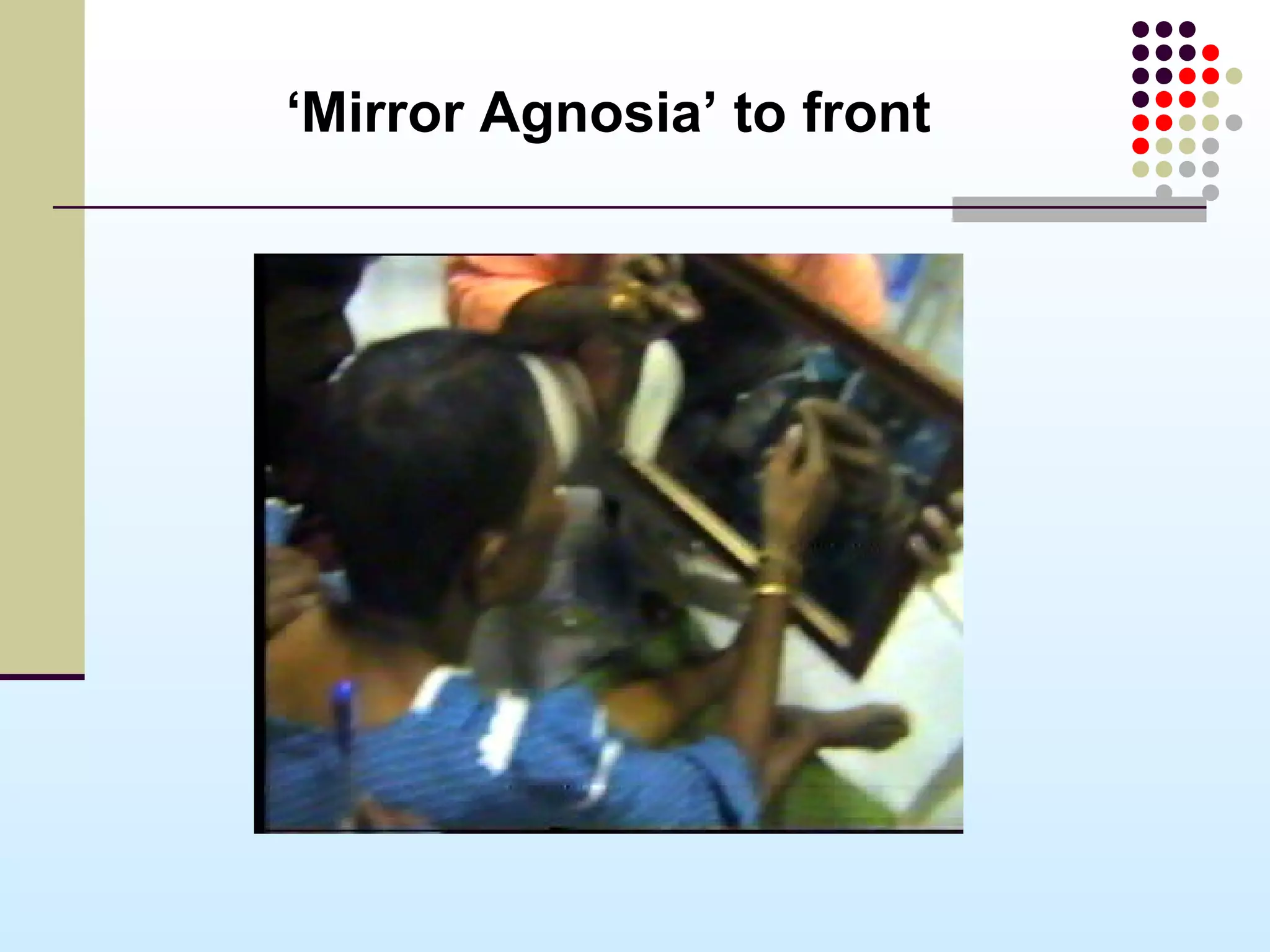 Unconscious sensory perception in a case of hemineglect | PPT