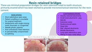 UNCONVENTIONAL BRIDGES: INNOVATIVE APPROACH IN MODERN PROSTHODONTICS.pptx