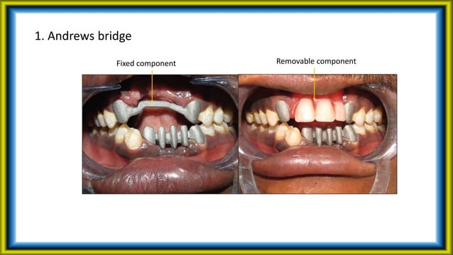 Unconventional fixed partial dentures | PPTX