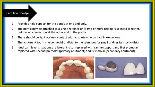 Unconventional fixed partial dentures | PPTX