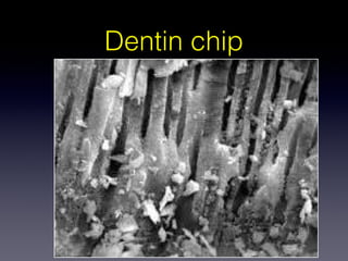 Under filled root canal | PPT