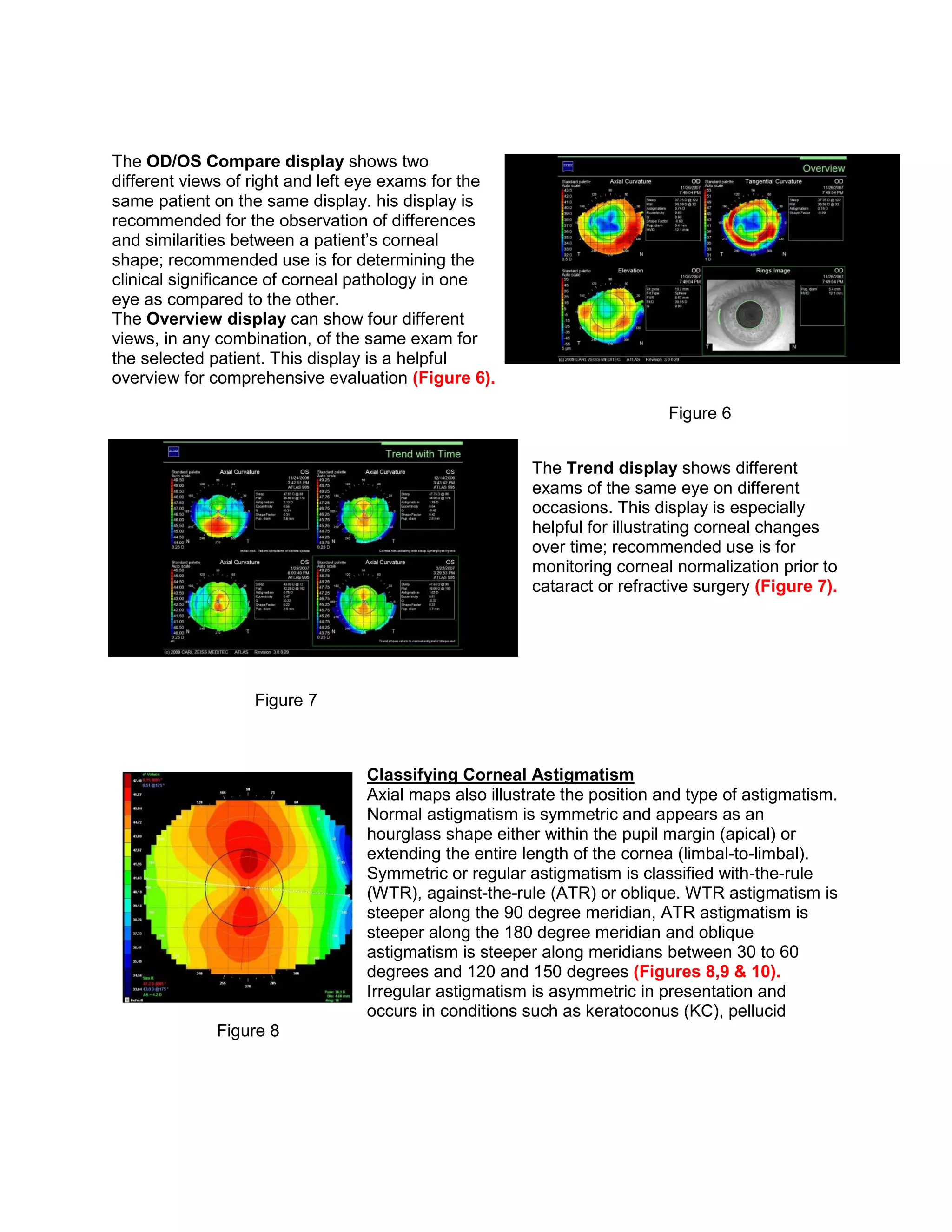 Understanding corneal-topography | PDF