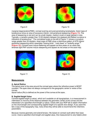 Understanding corneal-topography | PDF
