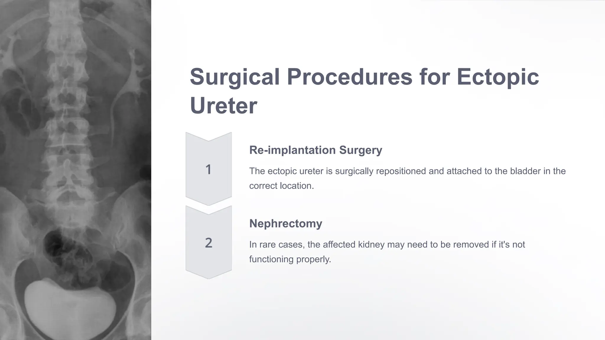 Understanding basics of -Ectopic-Ureter.pptx